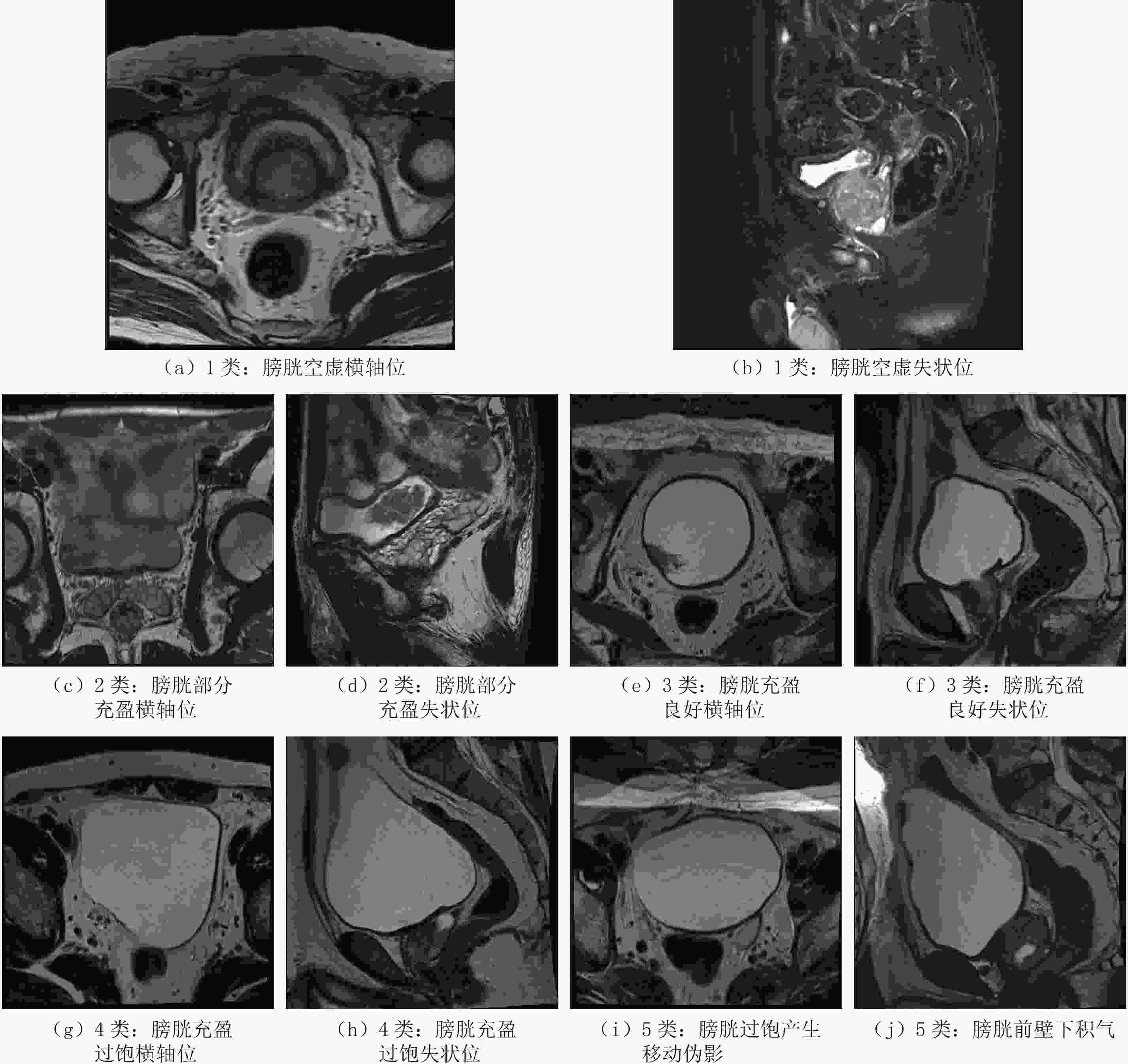 两种膀胱准备方式在膀胱癌磁共振成像及术前鉴别肿瘤肌层浸润效能中的探索研究